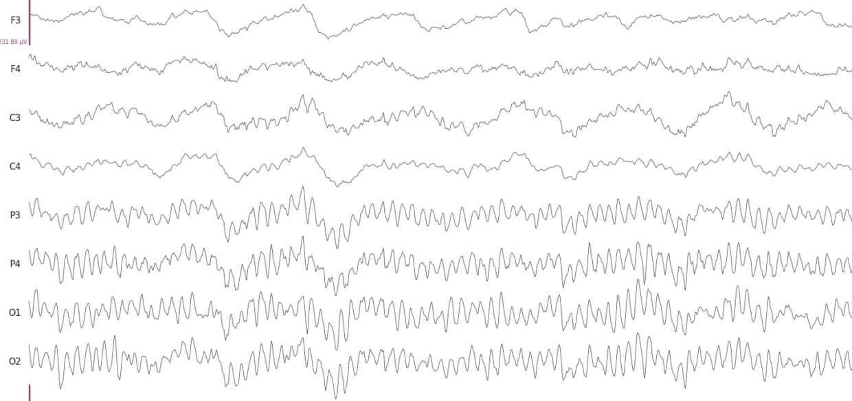 EEG (Electroencephalography) - BrainAccess