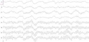 EEG (Electroencephalography) - BrainAccess