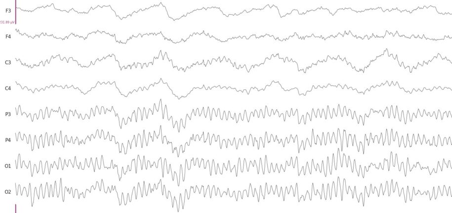 EEG (Electroencephalography) - BrainAccess