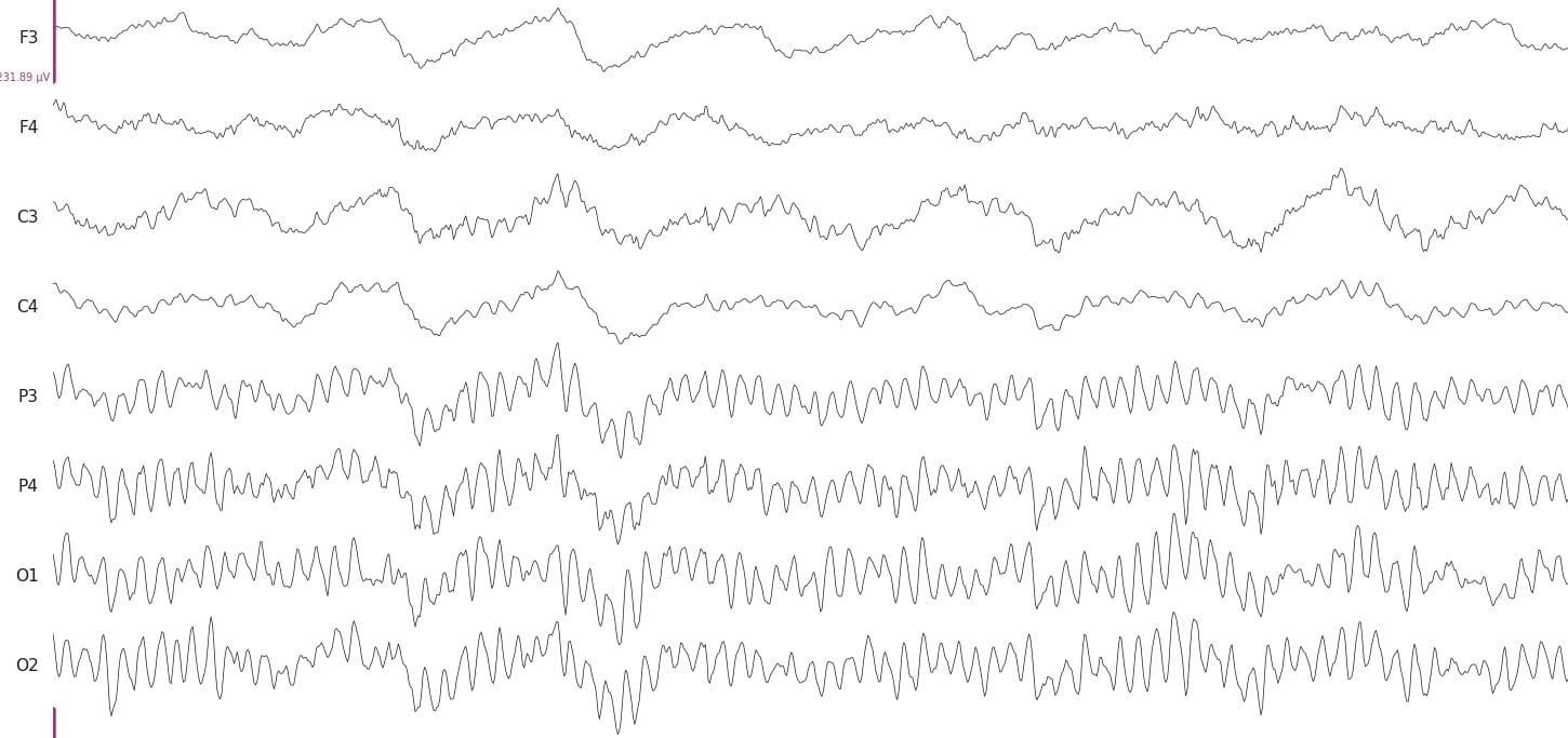 Eeg Electroencephalography Brainaccess